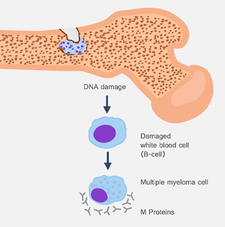 Stem Cell Therapy Multiple Myeloma - Stem Cell Tijuana